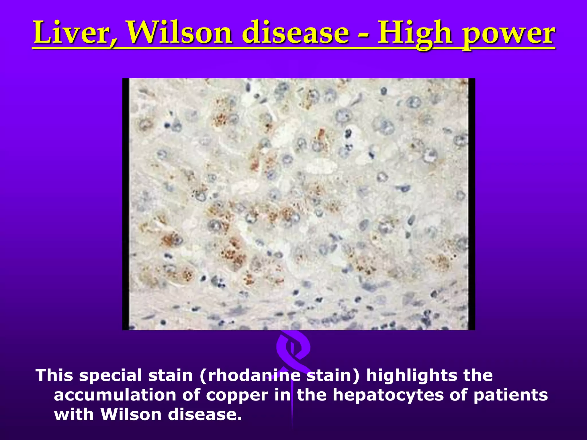 Liver biopsy interpretation | PPTX