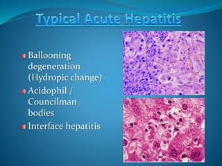 Liver biopsy interpretation | PPTX