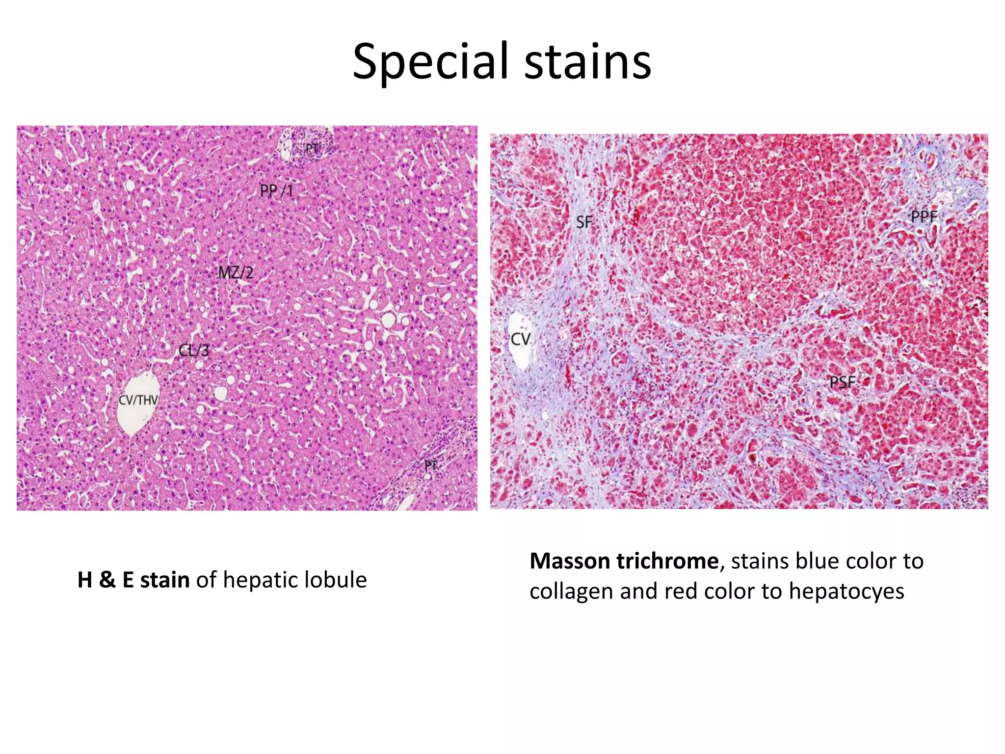 Liver Biopsy Interpretation: Special Stains – JCDAT