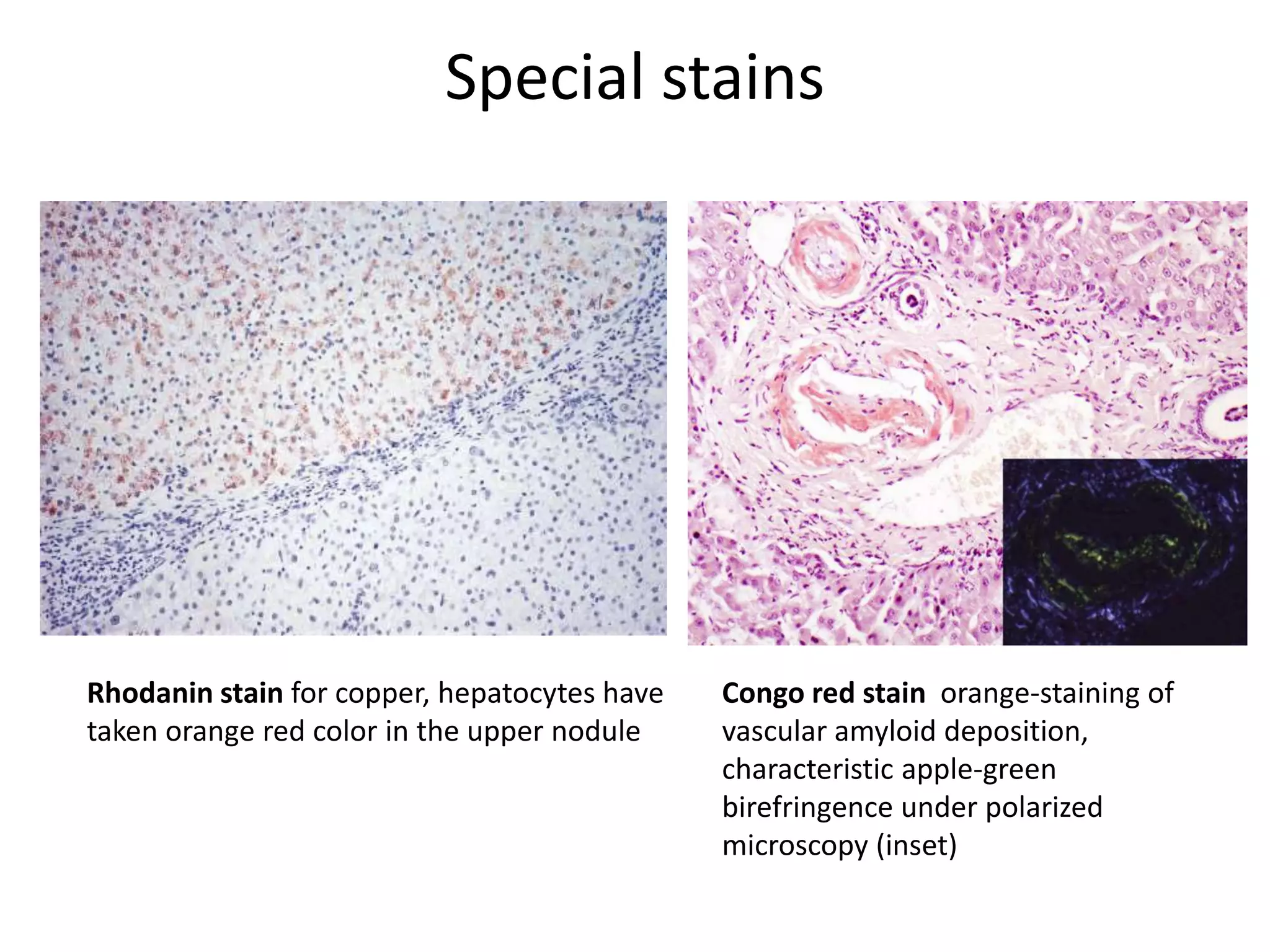 Liver biopsy interpretation | PPTX