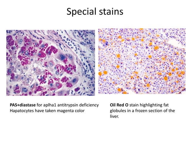 Liver biopsy interpretation | PPTX | Blood Disorders | Diseases and Conditions