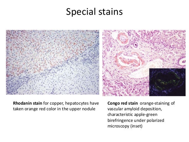 Liver biopsy interpretation
