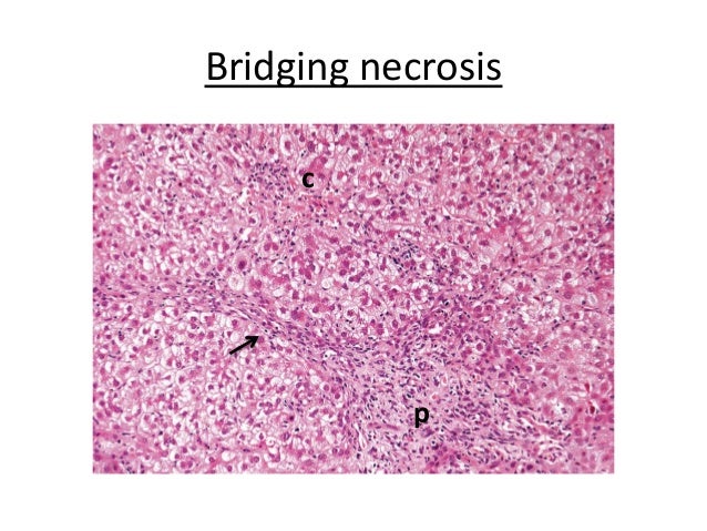 Liver biopsy interpretation