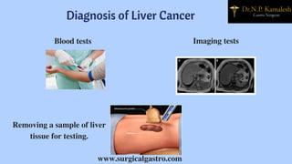 Liver Cancer Treatment In Kochi | Gastroenterologist In Kerala | PDF