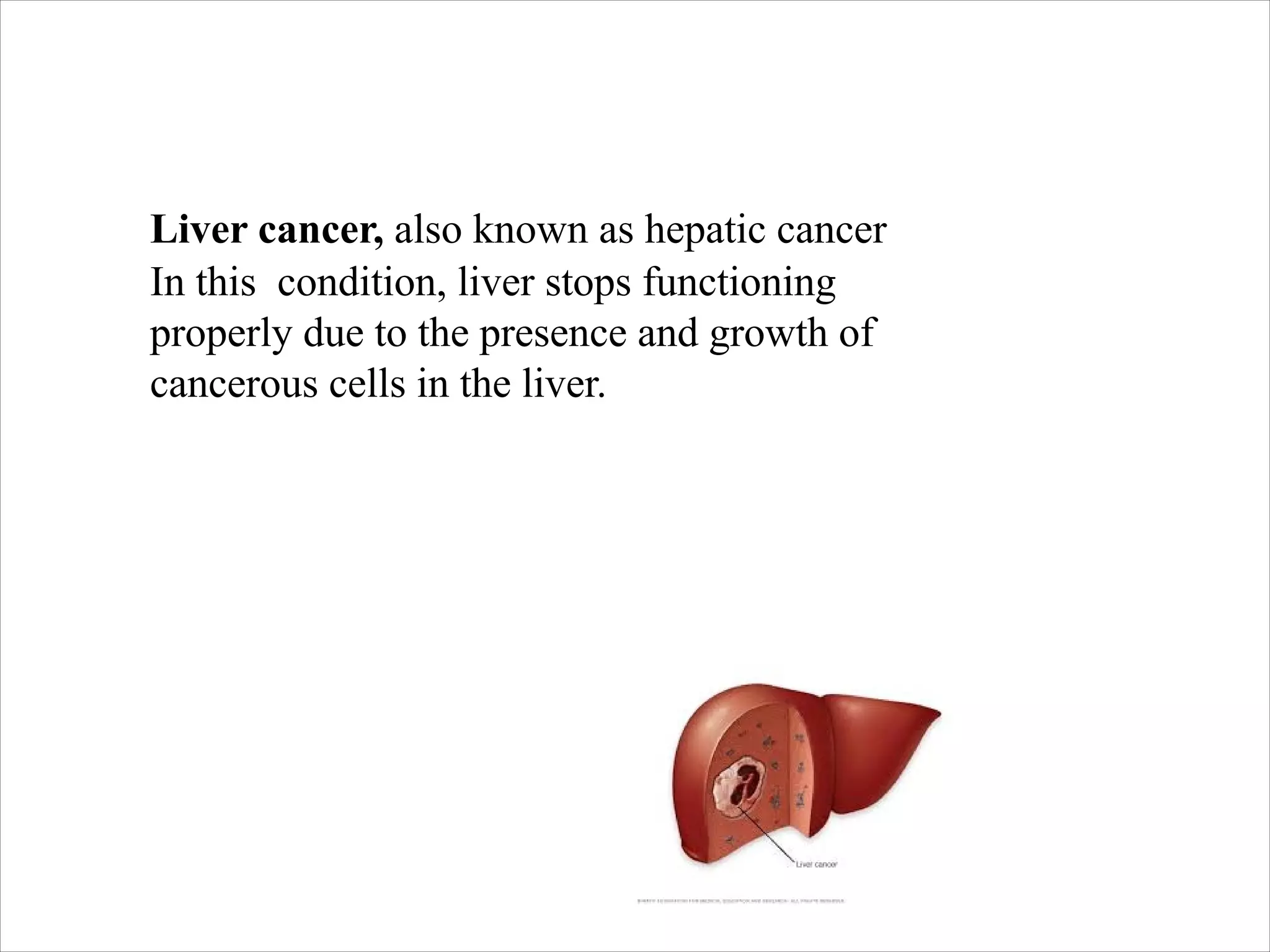 Liver cancer | PDF