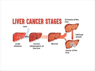 Liver Cancer Stages
