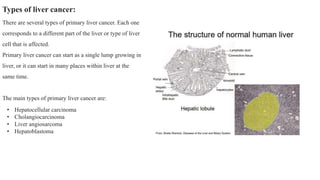 liver cancer.pptx