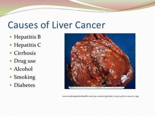 liver cancer and it's pharmacology and medical management.pptx