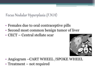 Liver cancer | PPTX