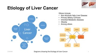 Liver Cancer: Epidemiology, Etiology, Prognosis and Treatment. | PPTX