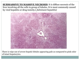 liver cell necrosis and its significance.pptx