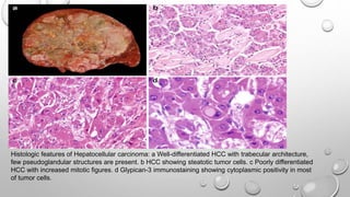 Liver cells carcinoma, liver cirrhosis, hepatitis(1).pptx