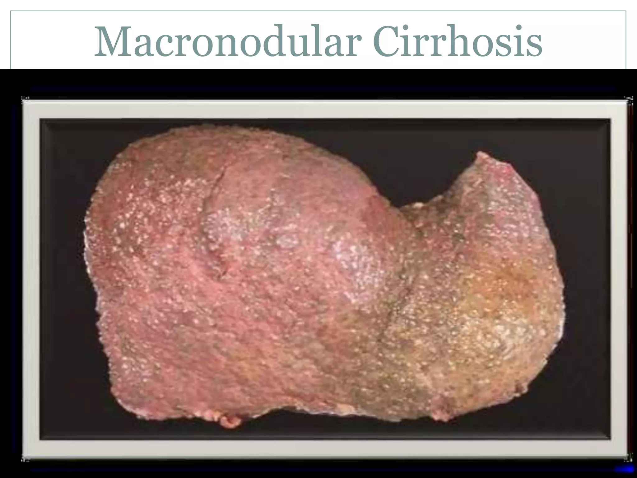 Liver cirrhosis | PDF