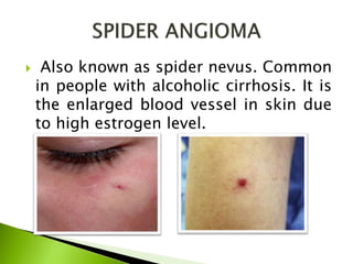 Spider Angiomas Alcohol
