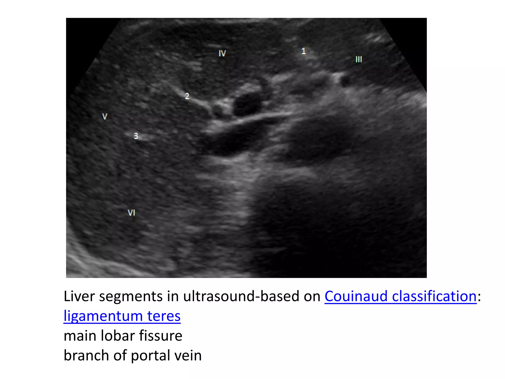 LIVER SEGMENTAL ANATOMY AND IMAGINGIN IN LIVER CIRRHOSIS.pptx | Medical ...