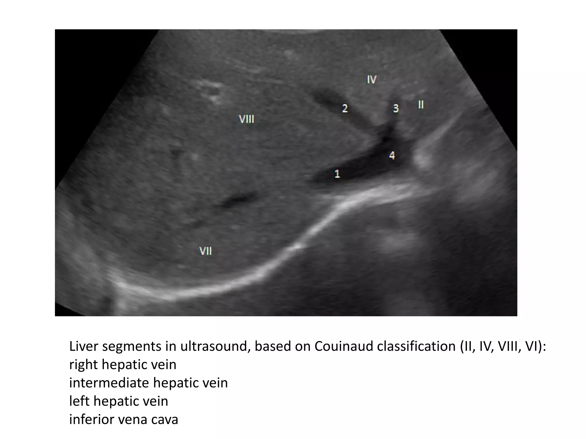 LIVER SEGMENTAL ANATOMY AND IMAGINGIN IN LIVER CIRRHOSIS.pptx