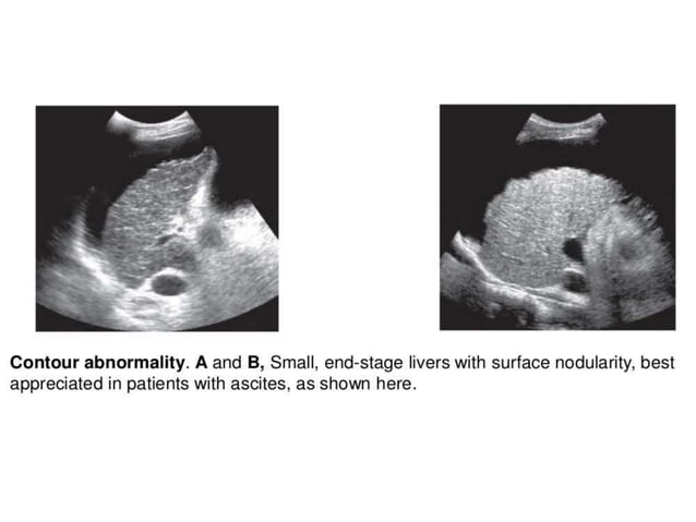 LIVER SEGMENTAL ANATOMY AND IMAGINGIN IN LIVER CIRRHOSIS.pptx