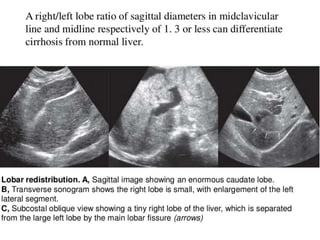 Main Lobar Fissure Ultrasound