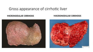 LIVER CIRRHOSIS new pathology medicines slides | PPT