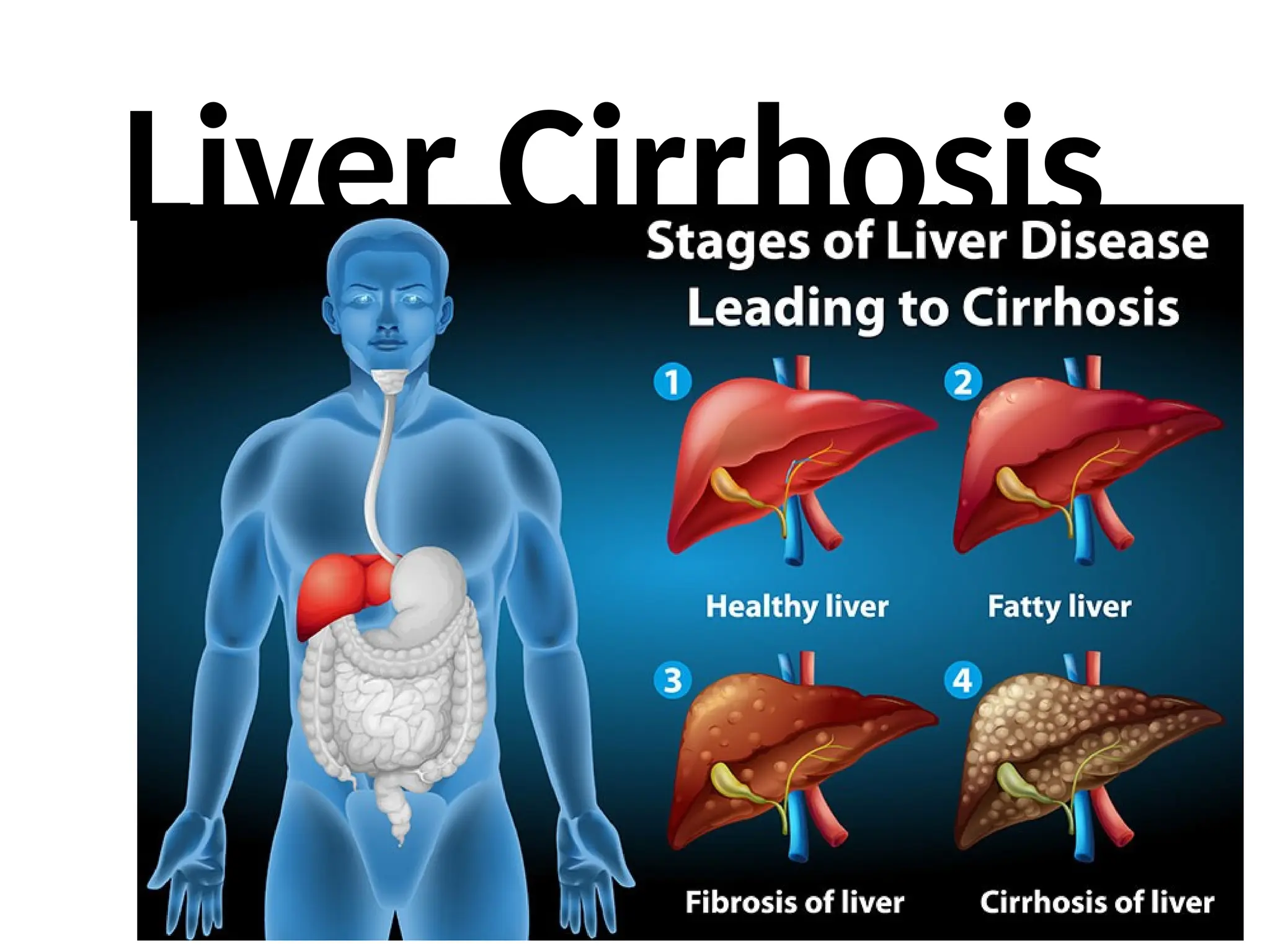 LIVER CIRRHOSIS: Risk, etiology, clinical manifestations, diagnostic evaluation and ...