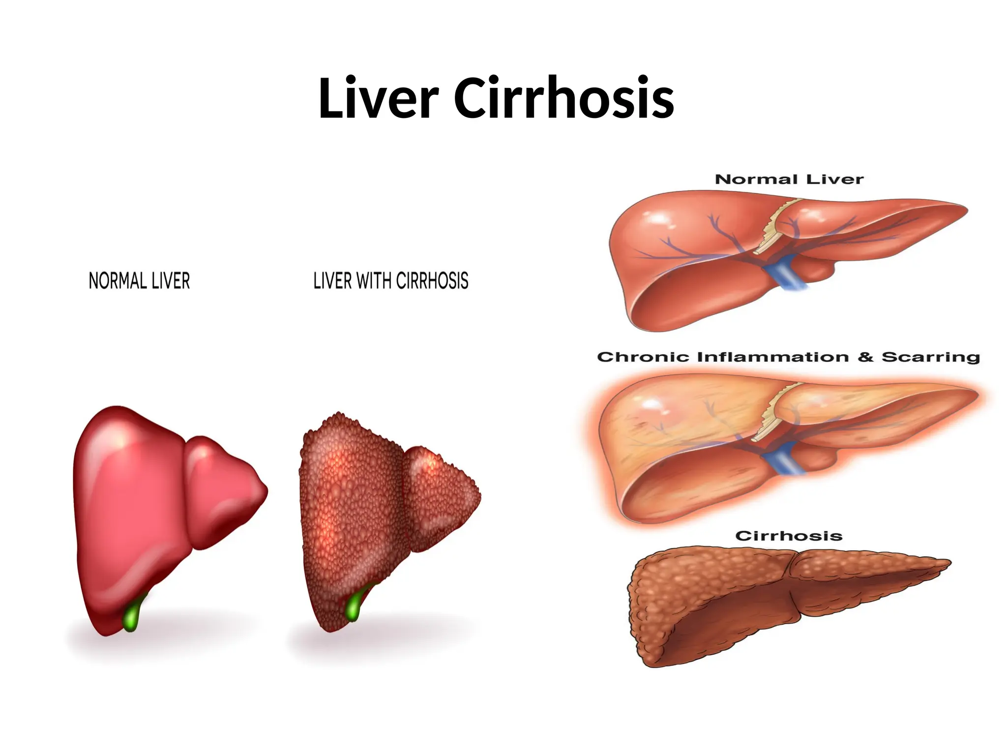 LIVER CIRRHOSIS: Risk, etiology, clinical manifestations, diagnostic evaluation and ...
