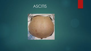 Liver cirrhosis ppt | PPTX