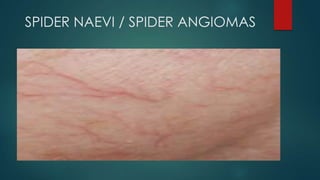 Liver cirrhosis ppt | PPTX