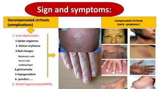 Liver cirrhosis and its sign,symptums,complication... | PPTX