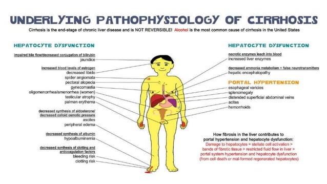 Pathophysiology of liver cirrhosis and alcholoic liver disease | PPTX