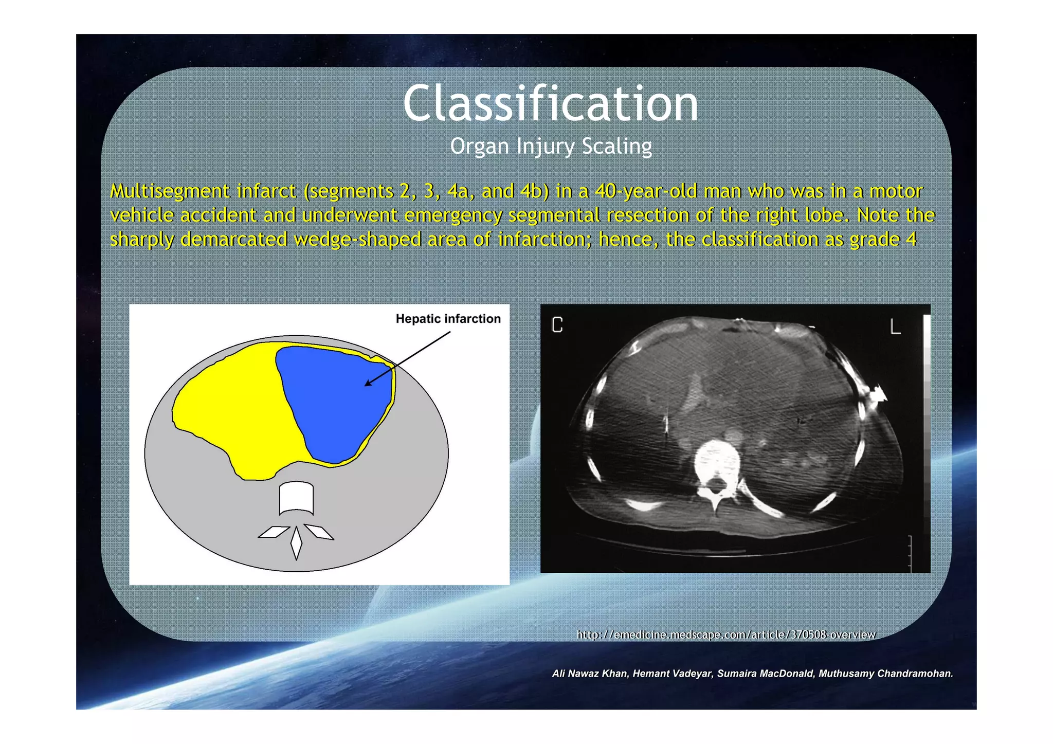 Liver Trauma: Classification | PDF