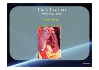 Liver Trauma: Classification | PDF