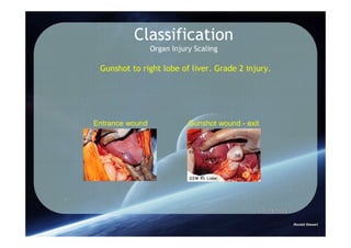 Liver Trauma: Classification | PDF