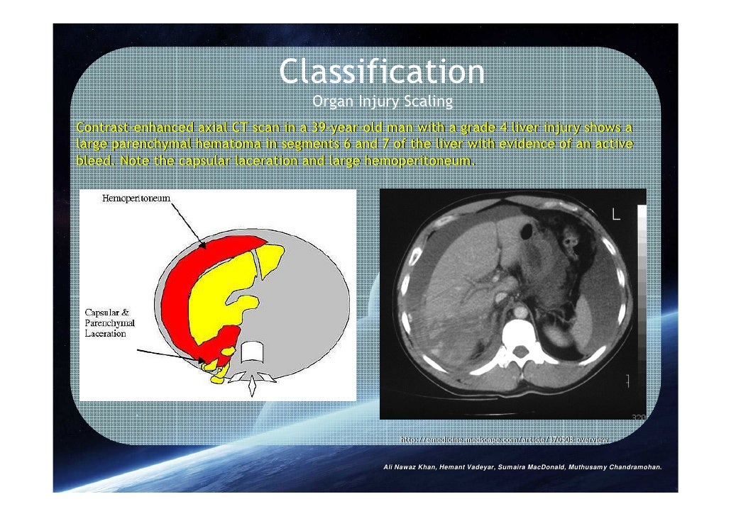 Liver Trauma: Classification