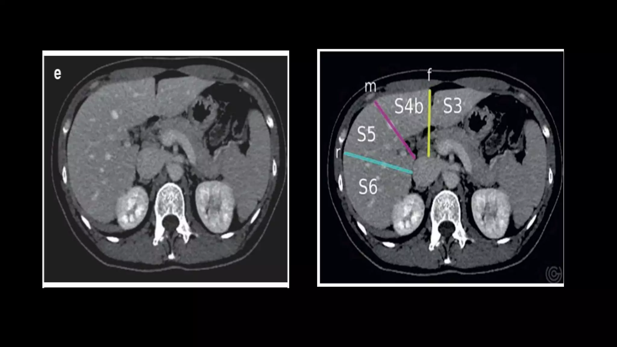 Liver ct anatomy(1).pptx