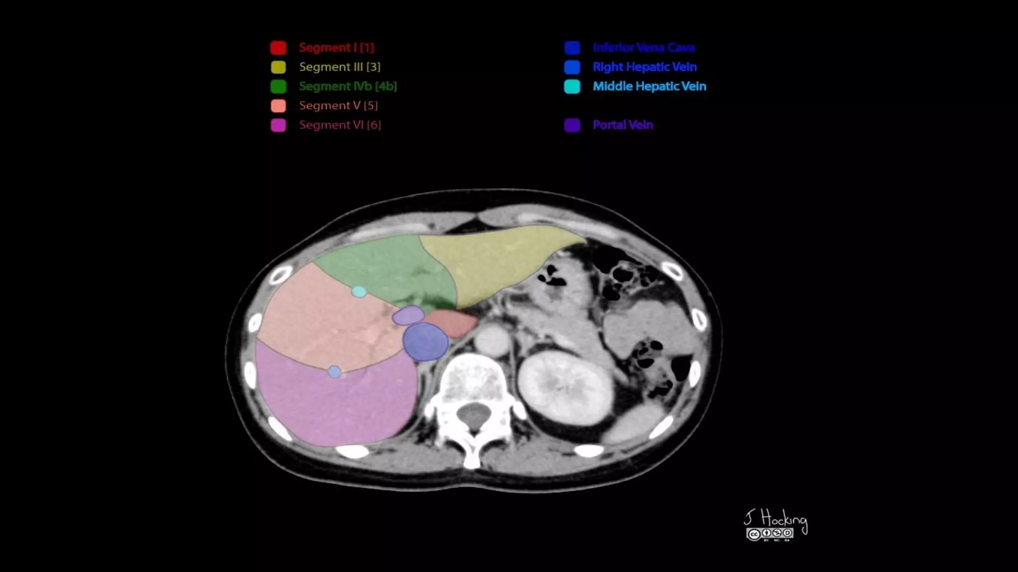 Liver ct anatomy(1).pptx