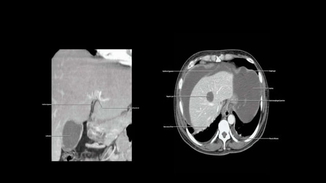Liver ct anatomy(1).pptx