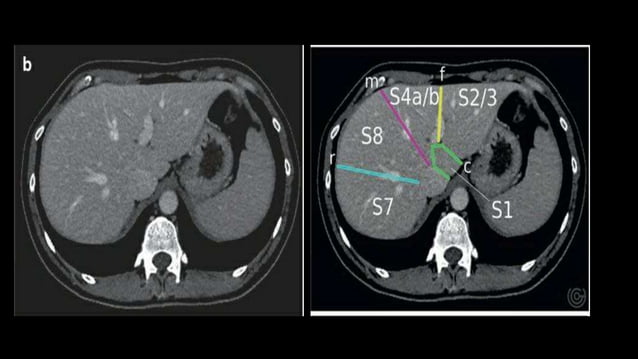 Liver ct anatomy(1).pptx