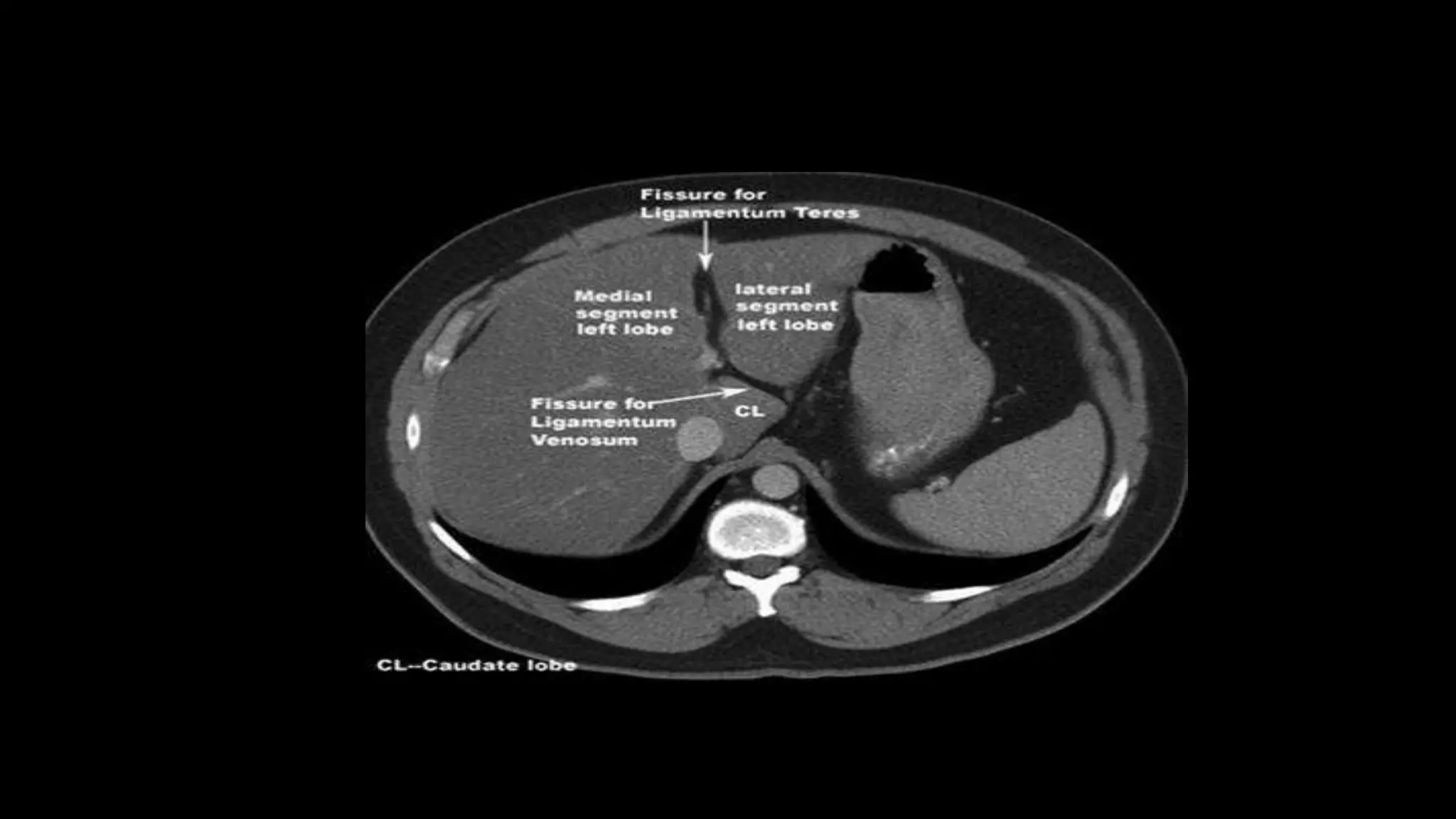Liver ct anatomy 2.pptx