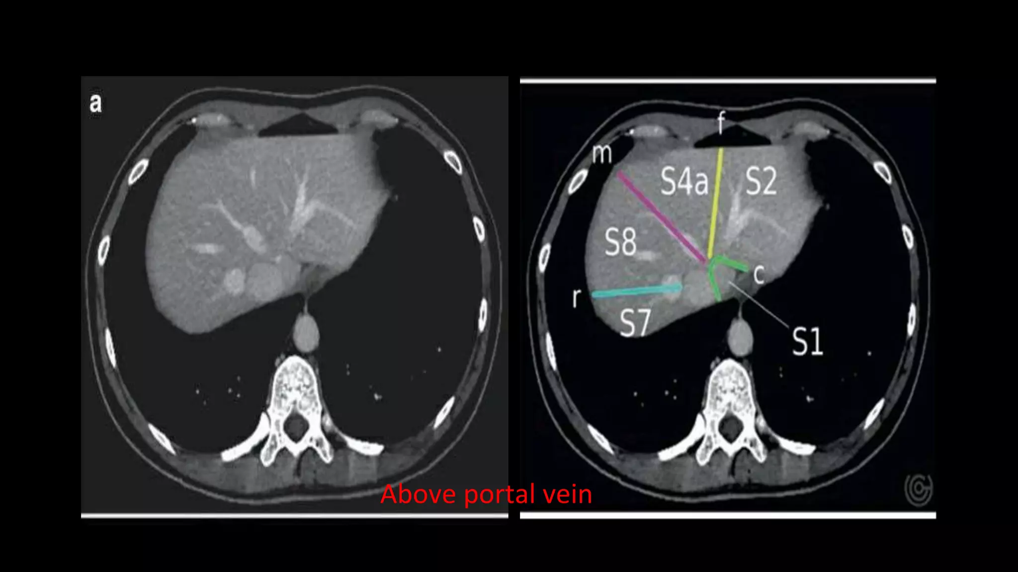 Liver ct anatomy 2.pptx | Digestive Disorders | Diseases and Conditions