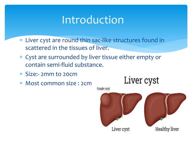Liver Cyst.pptx