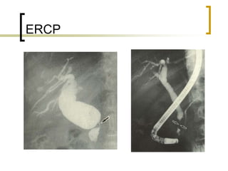 Liver cysts , Abscesses and Tumors | PPT