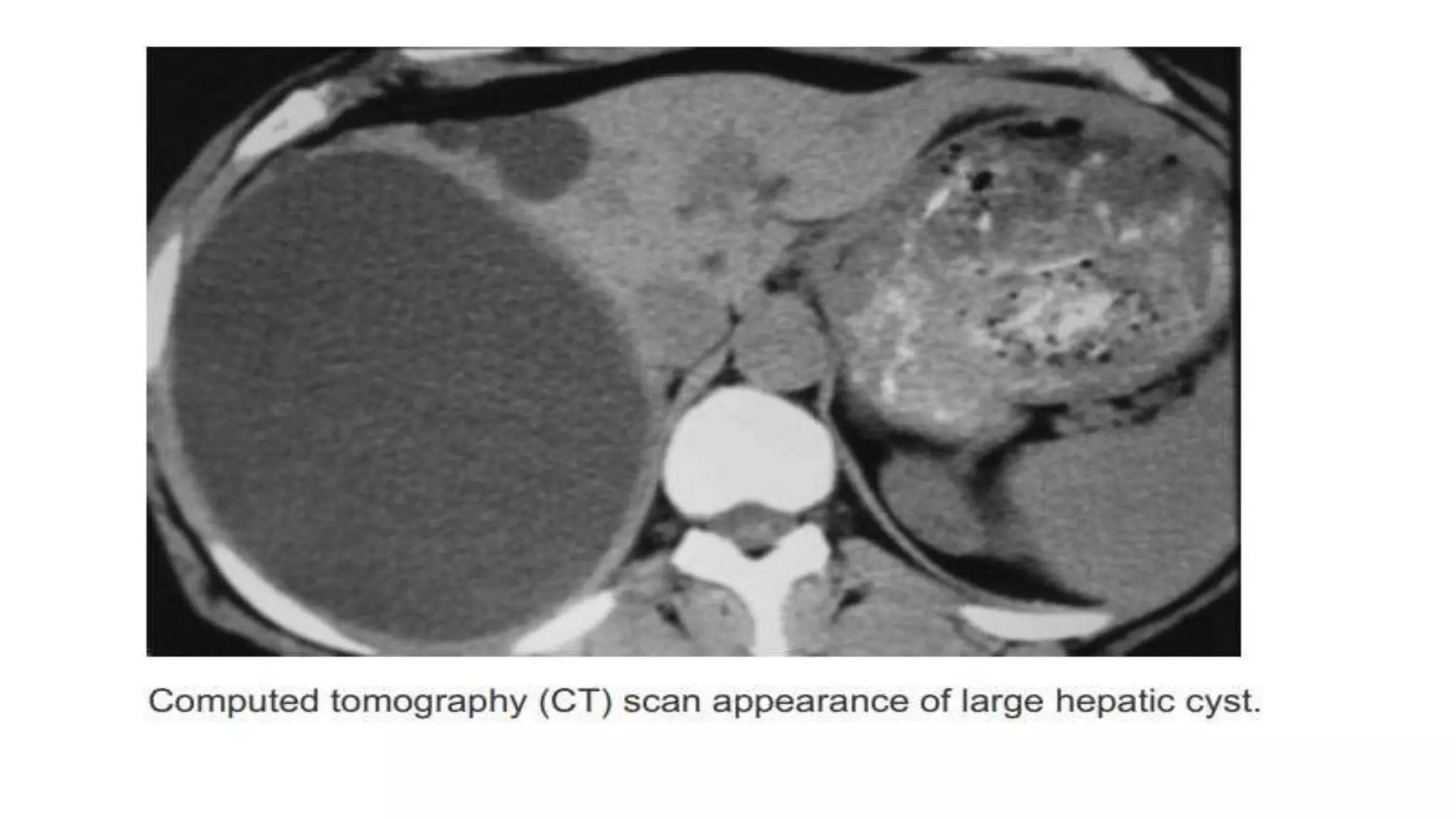 Liver Cysts and Abscesses | PPTX
