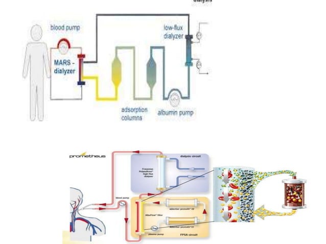 Liver dialysis | PPTX
