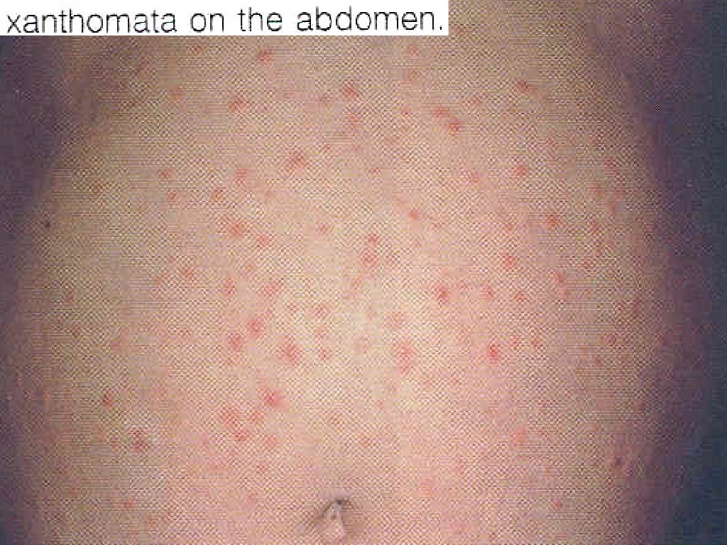 Liver Disease Skin Rashes Images, Photos | Mungfali Liver Disease Skin Rashes Images, Photos | Mungfali