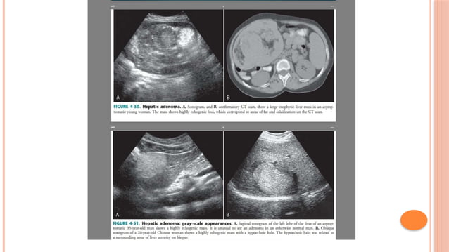 liver disease in ultrasound evaluat.pptx