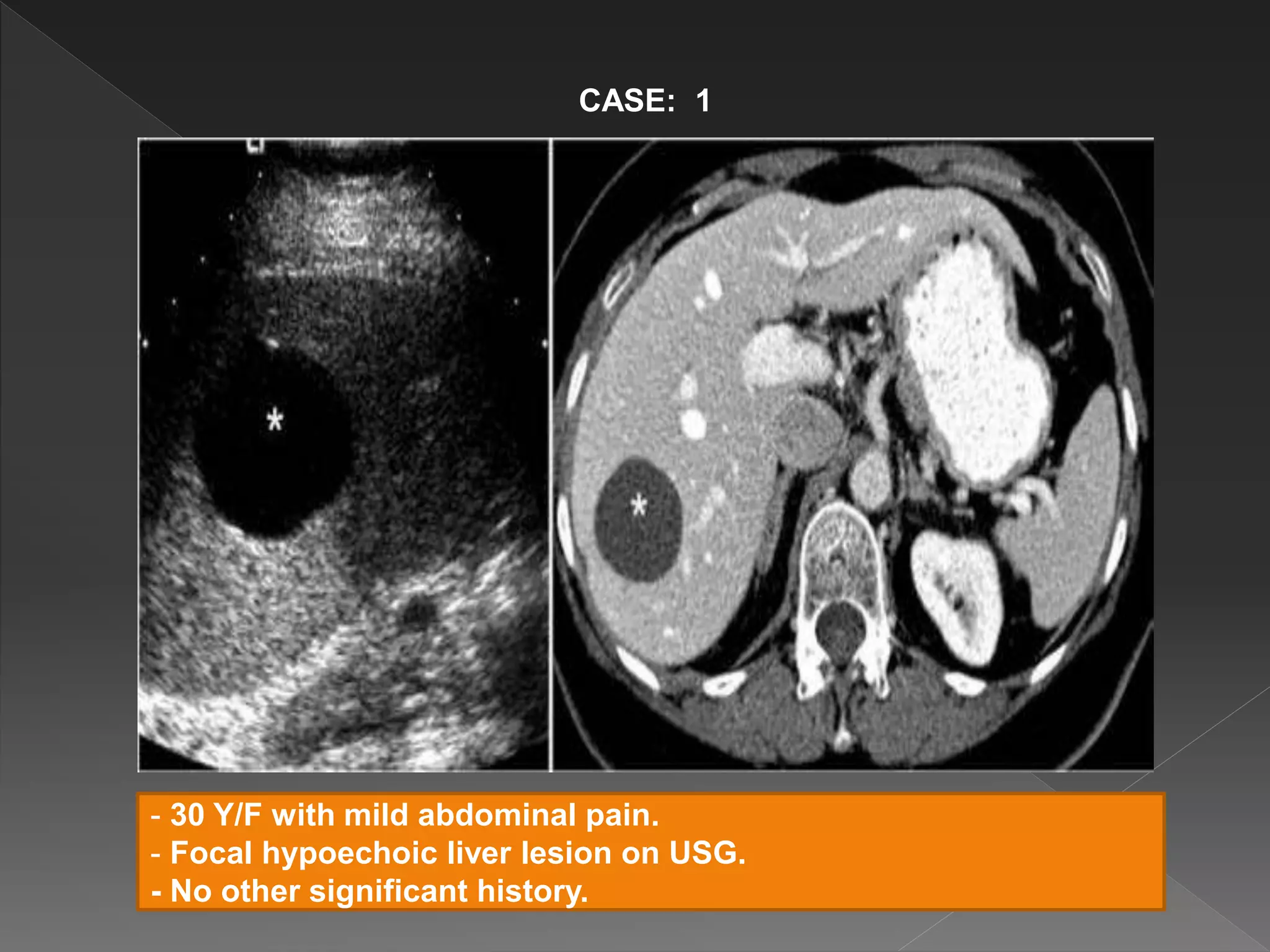 Liver imaging ct scan algorithm | PPTX