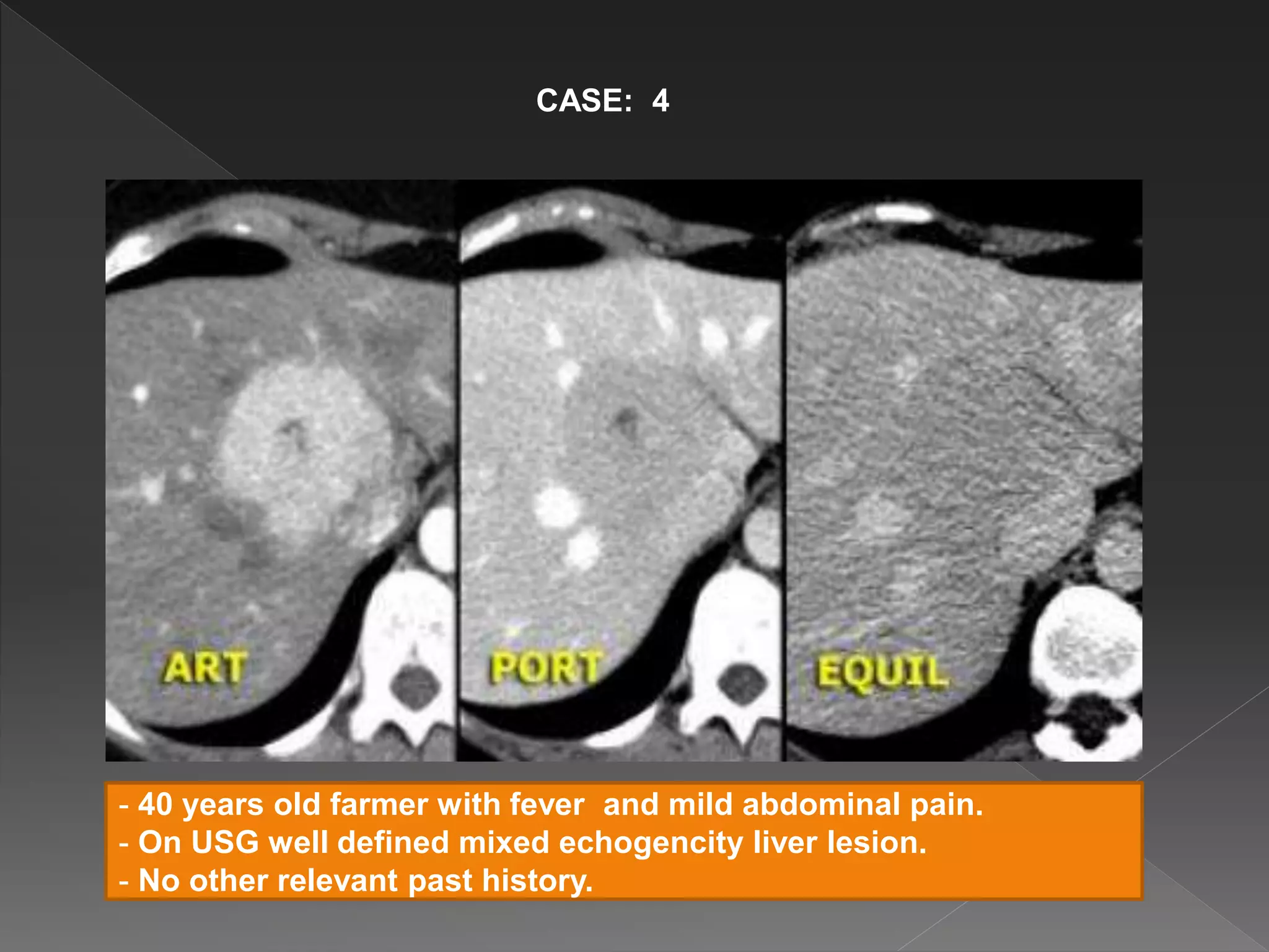 Liver imaging ct scan algorithm | PPTX