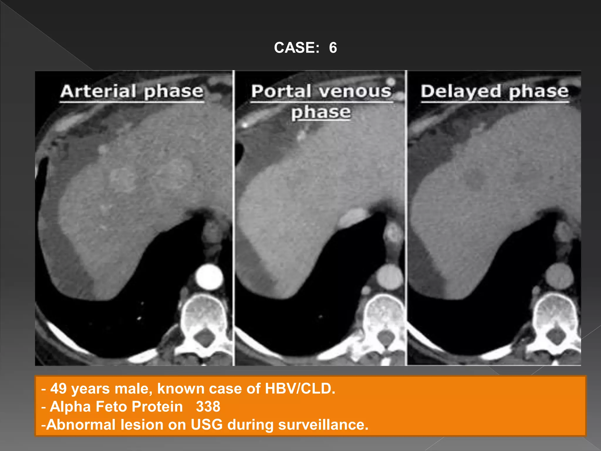 Liver imaging ct scan algorithm | PPTX
