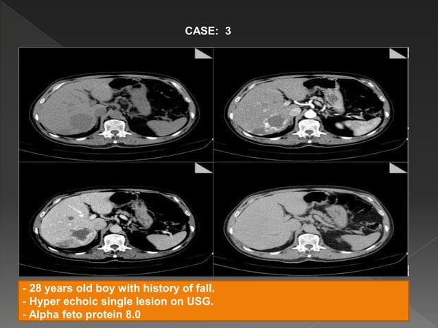 Liver imaging ct scan algorithm | PPTX | Lung and Respiratory Health ...
