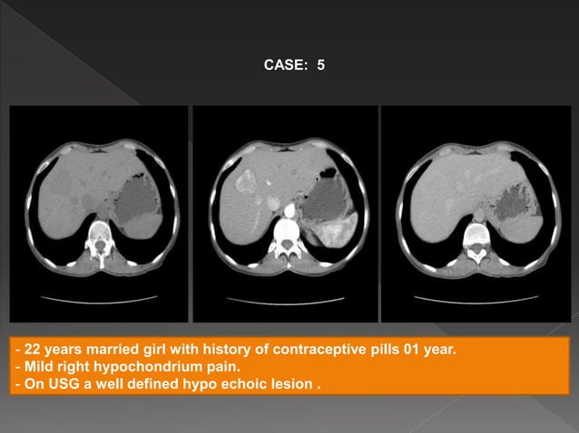 Liver imaging ct scan algorithm | PPTX | Lung and Respiratory Health ...
